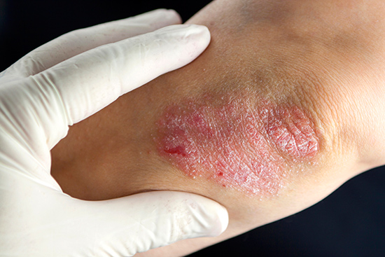 World Psoriasis Day – Knoxville Institute of Dermatology